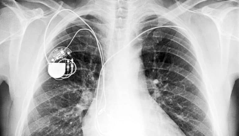 Ai Can Improve Xray Identification Of Pacemakers In