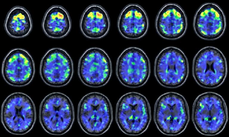 Can brain scans spot CTE in the living? - Futurity